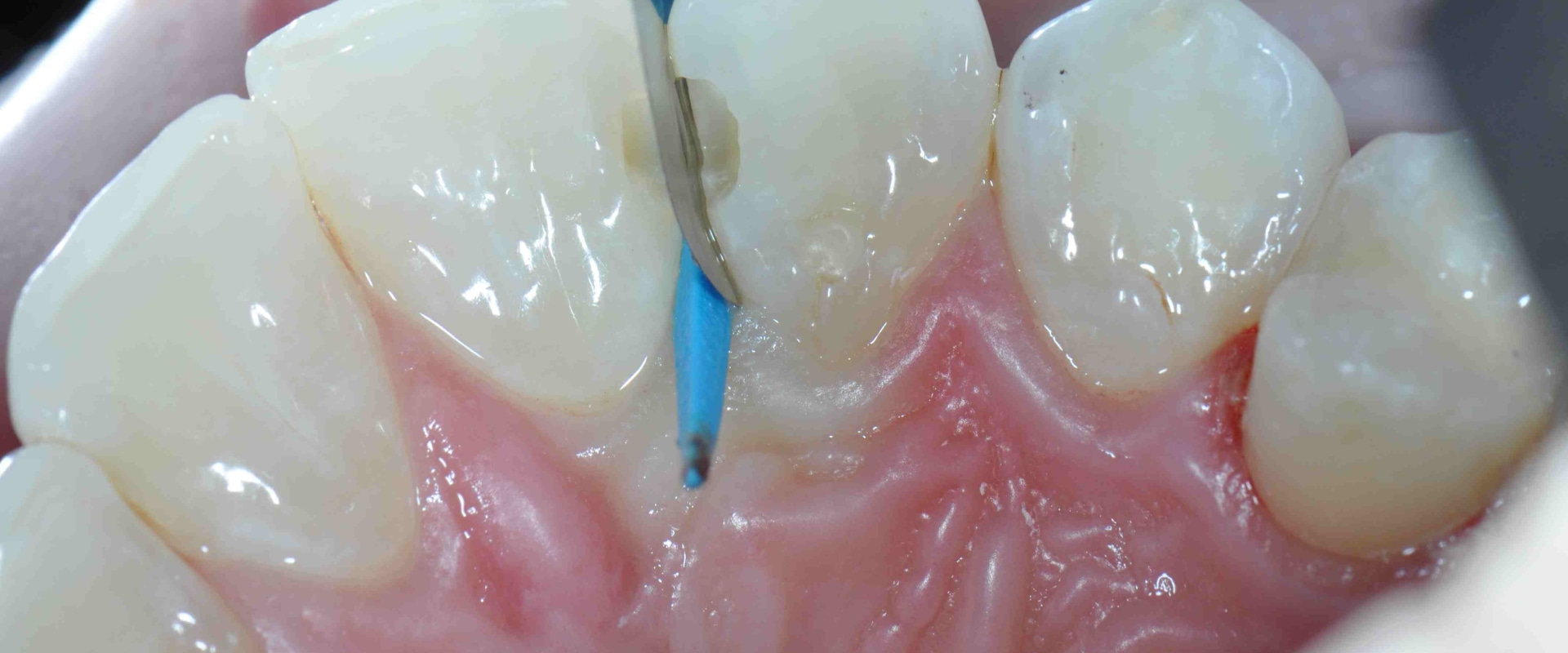 Which Material is the Most Commonly Used for Class III Dental Restorations?