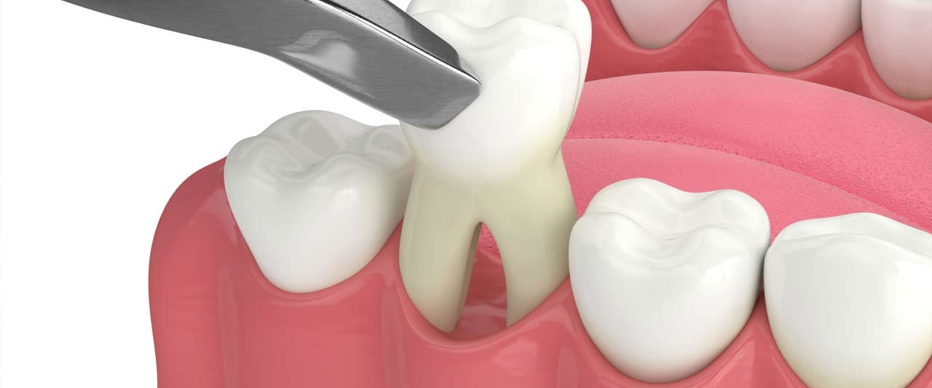 What to Expect After a Dental Procedure